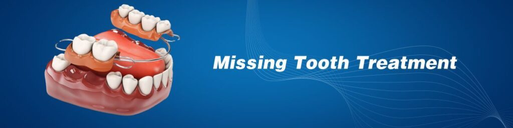 Missing Tooth Treatment - tathastudental.com